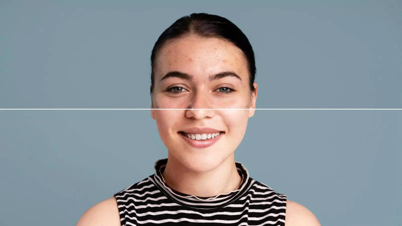 Dietary Solutions For Acne: Eight Ways To Achieve Clearer Skin
