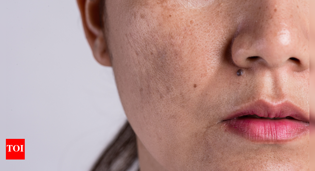 What is Melasma: What are its triggers and prevention strategies ...