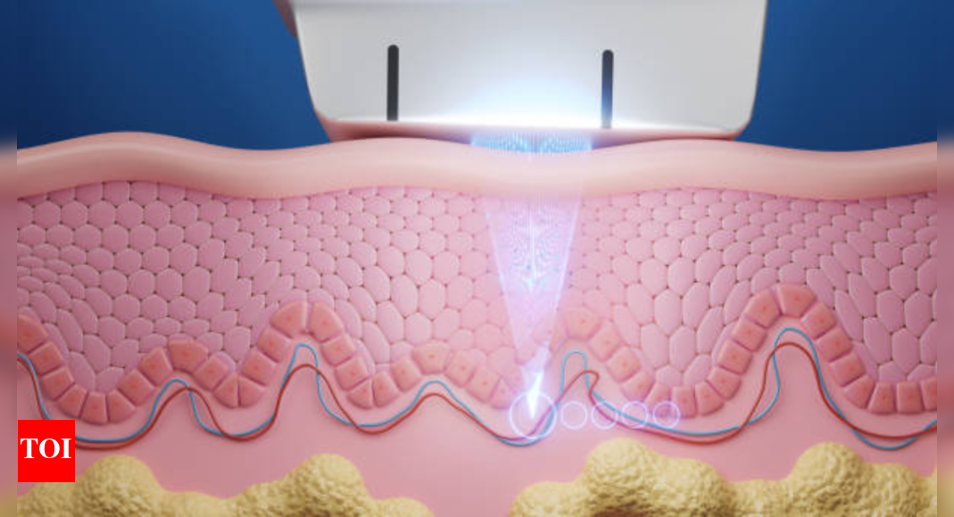 What to expect during and after Ultherapy treatment - Times of India