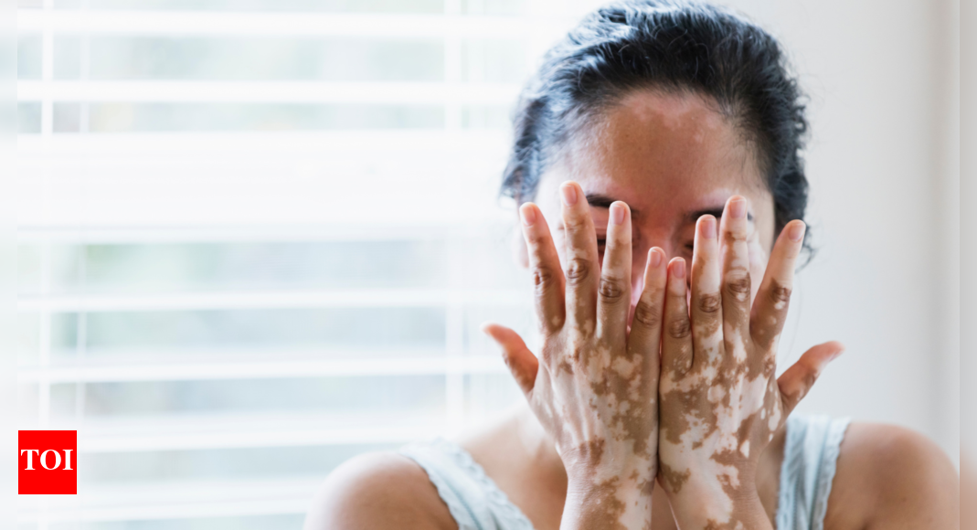 All you need to know about vitiligo - Times of India