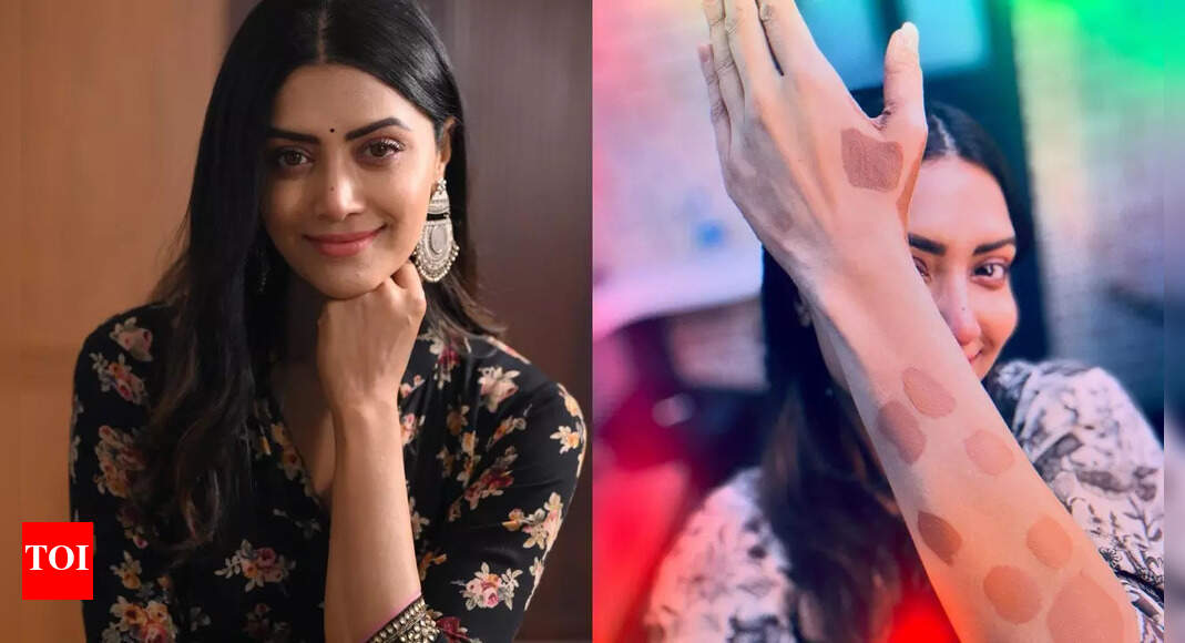 Mamta Mohandas proudly embraces her skin condition on World Vitiligo ...