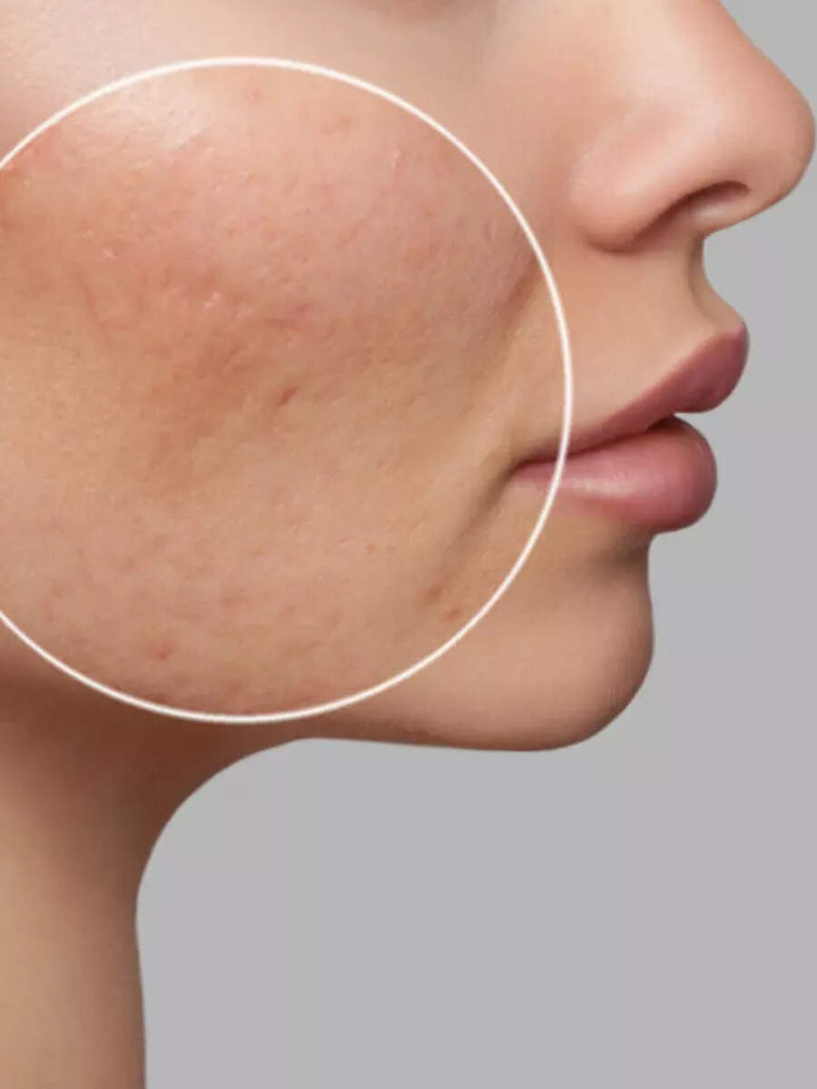 Open Pores Face Packs: Best face packs to close your open pores | Times ...