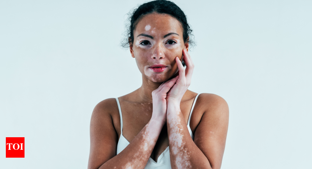 Vitiligo patients develop emotional, psychological stress: Know the ...