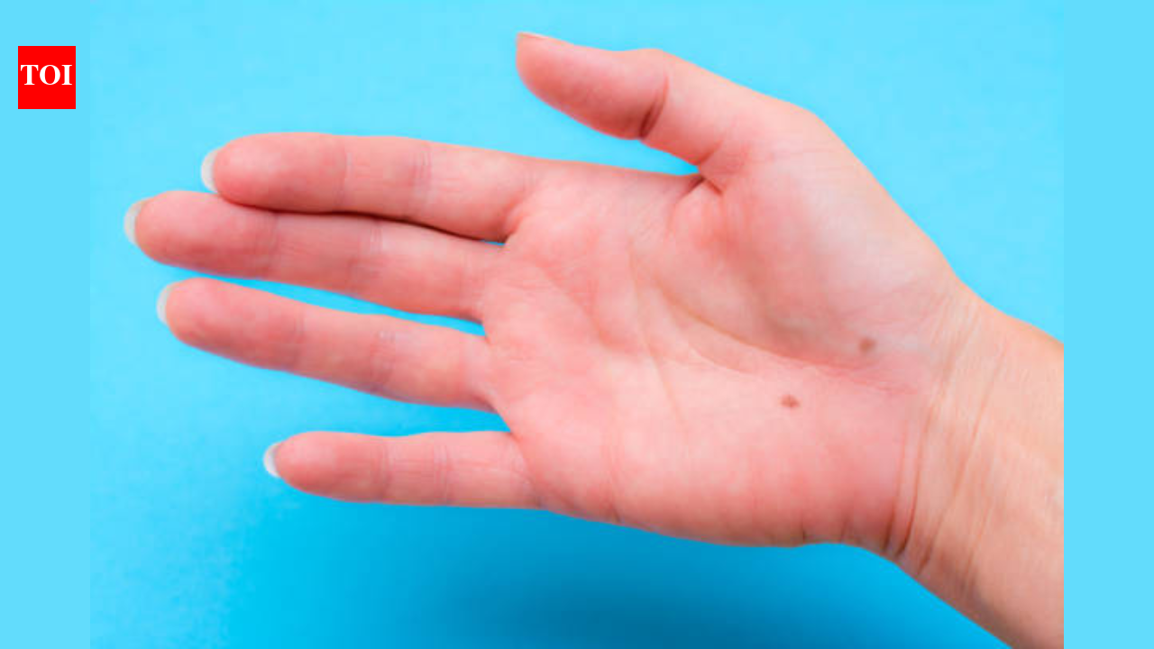 What do moles on different parts of the hand mean? - The Times of India