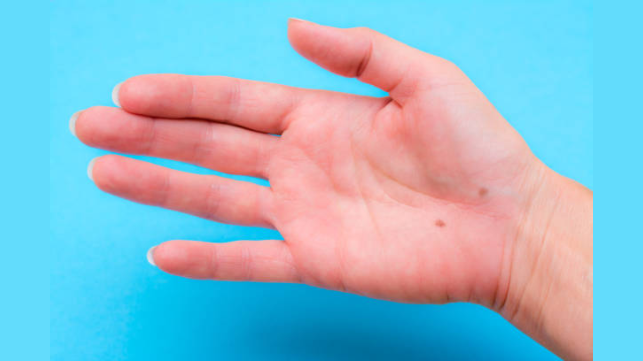 Palmistry Spots On Hand
