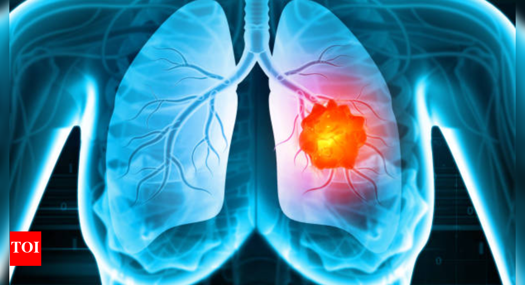 No cough, still cancer? Exploring lung cancer signs - Times of India
