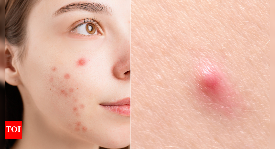 Difference between pimples and acne: How to heal them? - Times of India