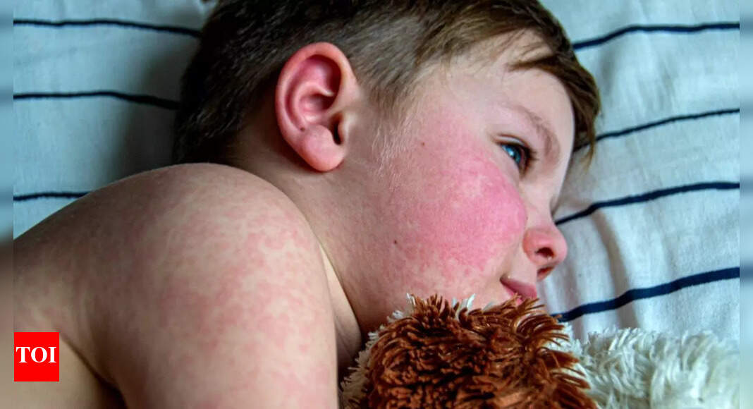 Parvovirus: What is slapped cheek syndrome? Know all about the fast ...