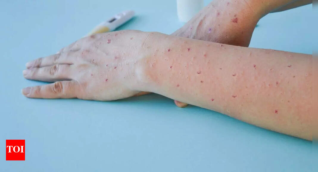 Mpox in kids: 10 early signs and symptoms found in children - The Times ...