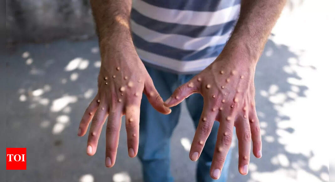 Mpox danger signs: 6 severe symptoms to watch out for amid outbreak ...
