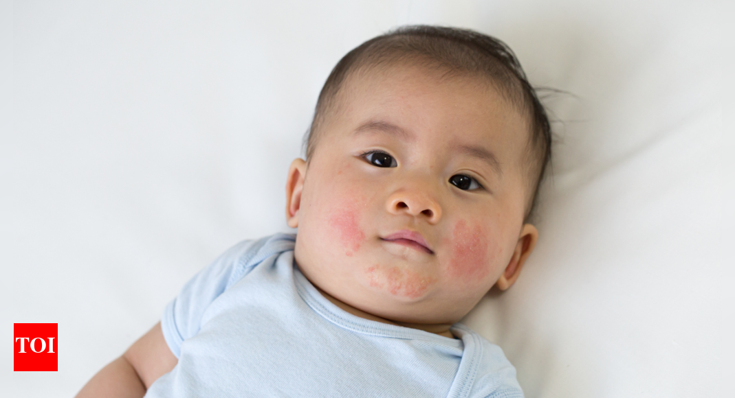 How to manage eczema in babies - Times of India
