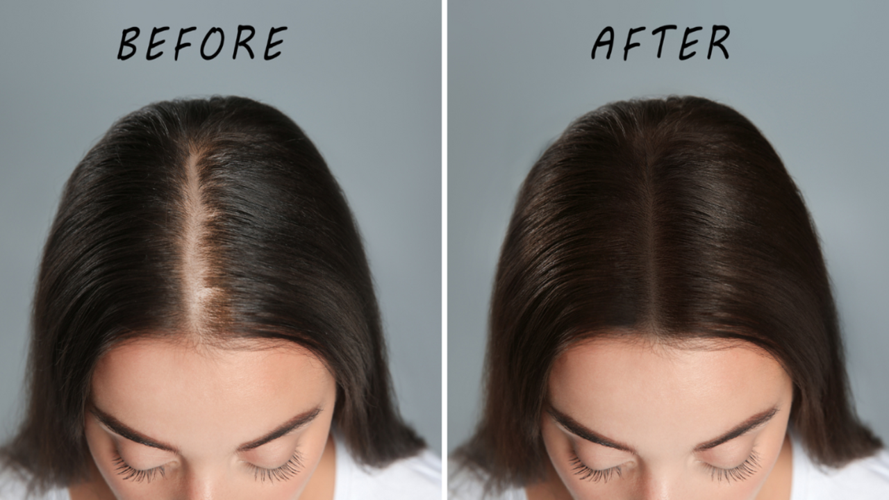 Does Hair Growth Oil Work On Bald Spots - Infoupdate.org