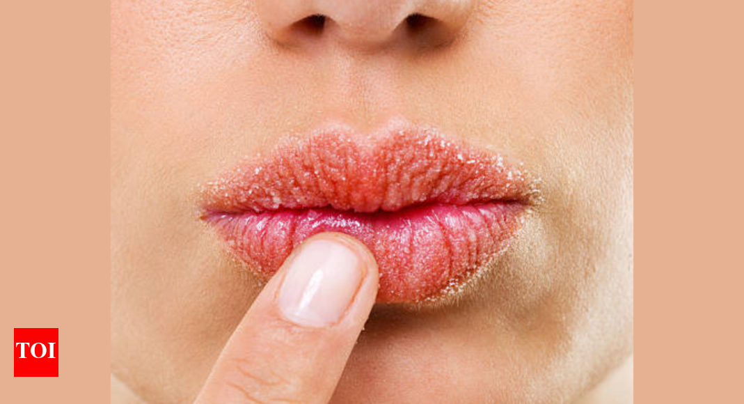 Chapped lips and skin cracking: Tips for preventing winter dryness ...
