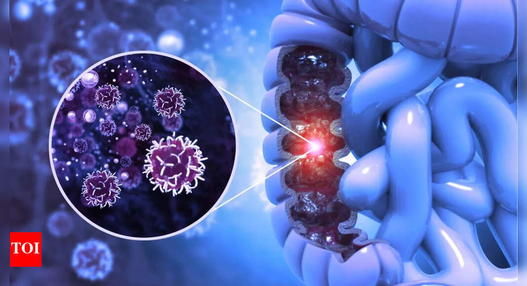 Colon Cancer: Unexpected colon cancer warning; This change in stool ...