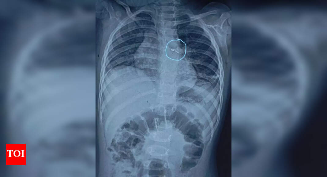 Pin removed from one-year-old’s airway in complex surgery | Madurai ...