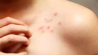 Dakshina Kannada Issues Chickenpox Prevention Guidelines for Schools ...