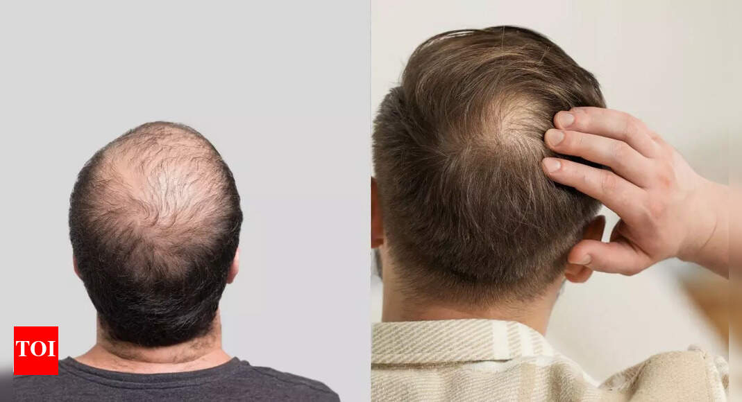 Shocking! What from Punjab and Haryana is causing balding in people ...