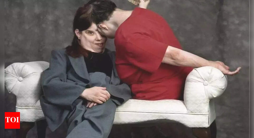 Oldest living conjoined twin shared hidden transgender identity with ...