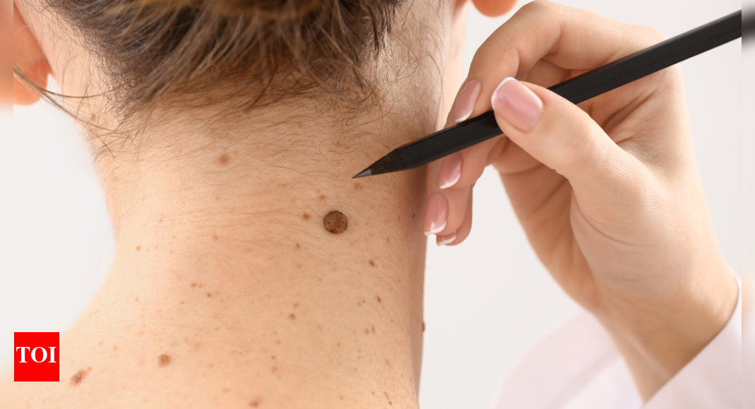 Moles Check: 6 reasons to get your newly occuring moles checked by a ...