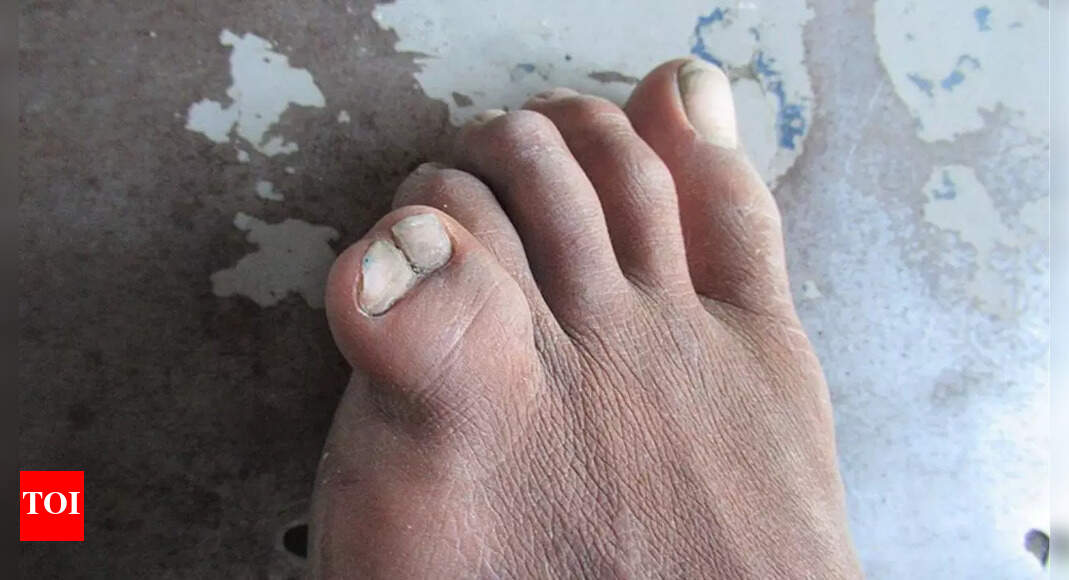 Why do some people have extra fingers and toes? Understand the science ...