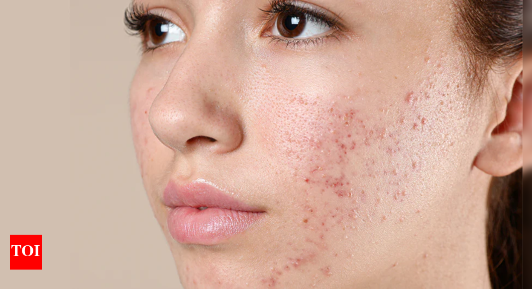 3 Effective DIY homemade masks for acne-prone oily skin | - The Times ...