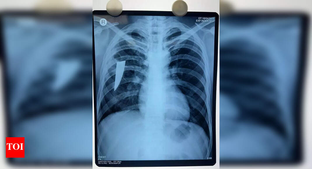 3 yrs after stabbing, knife piece removed from man’s lung | Bhubaneswar ...