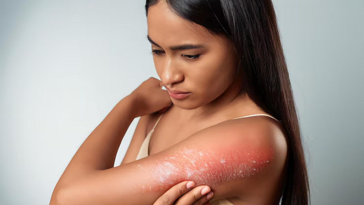 Rising Cases of Heat Rash: How to Keep Your Family Safe This Summer