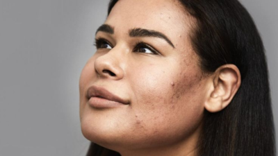 Summer acne struggles? Here’s how to keep breakouts at bay - Times of India