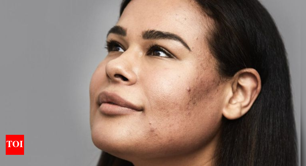 Summer acne struggles? Here’s how to keep breakouts at bay - Times of India