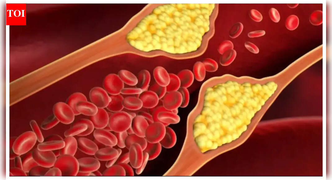 High Cholesterol: 6 symptoms of high cholesterol seen in body and face