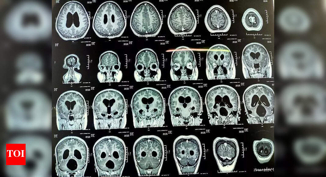 Extremely rare tumour removed from 12-year-old’s brain in Vadodara ...