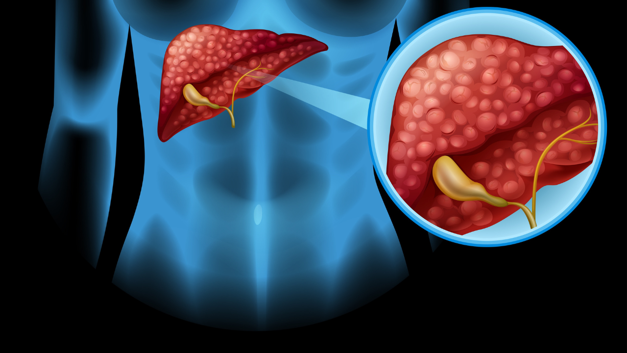 Liver Harming Foods: 3 common foods that are secretly harming the liver ...