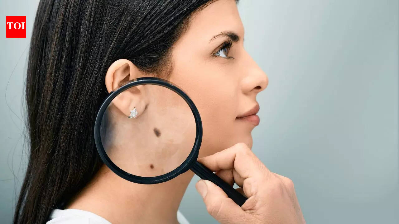 Skin Cancer Symptoms: Is that mole dangerous? How to spot early signs ...
