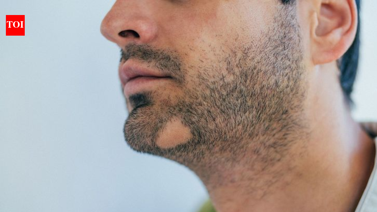 5 simple beard mask recipes to cover the unsightly bald patch