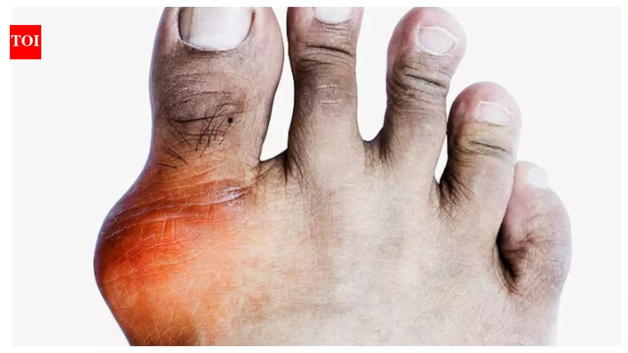 High Uric Acid Symptoms: 7 ways uric acid silently harms the body even ...