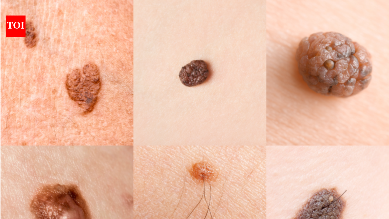 Skin Cancer Symptoms: 5 Early Signs of Skin Cancer That Are Easy to Miss