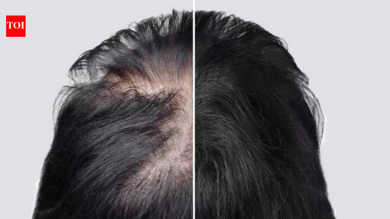 Hair Growth: 5 miracle oils that can actually help grow hair on bald ...