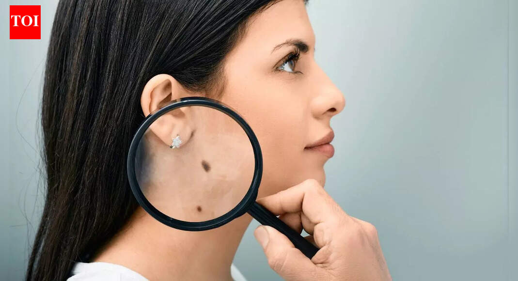 5 diseases moles on your body might indicate and should not be ignored