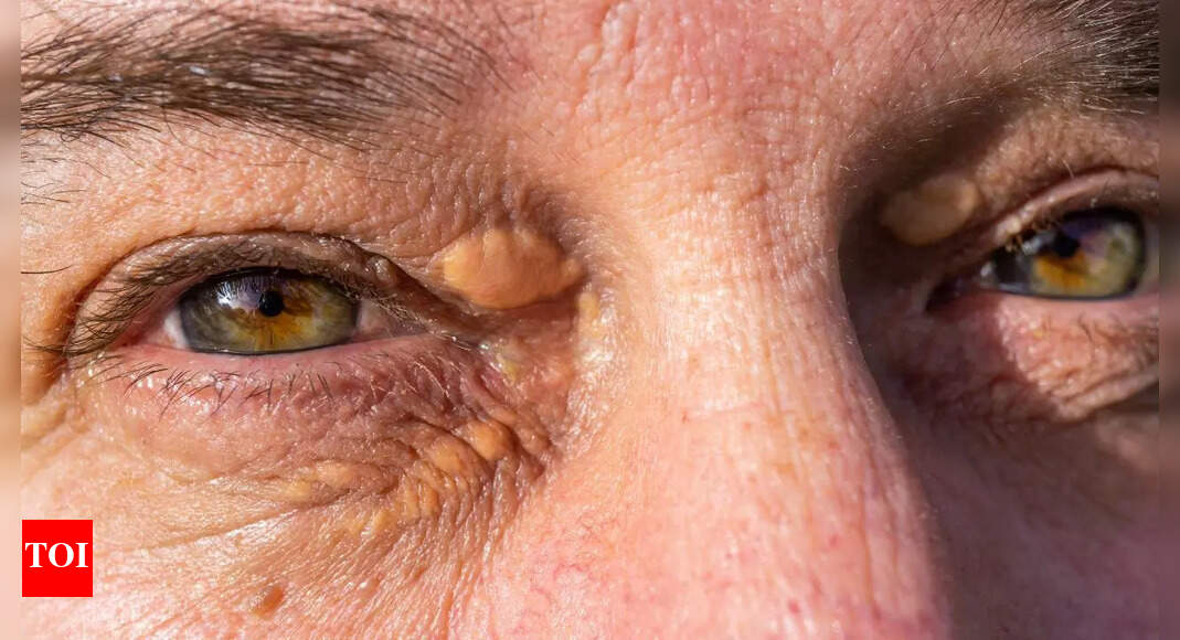 High cholesterol signs that appear on your skin before a heat test ...