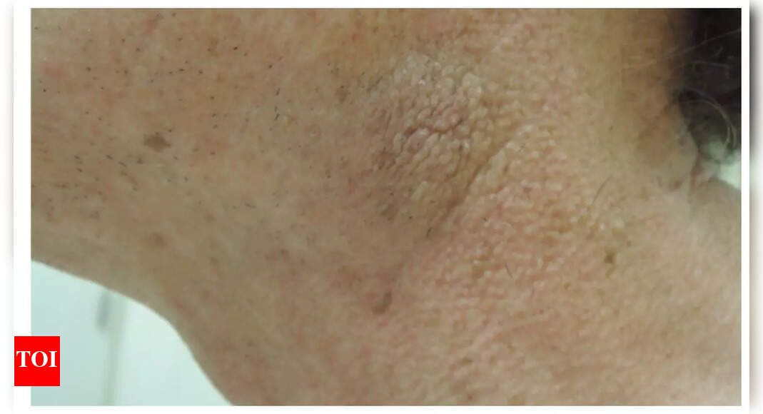 How Fear of Scars in Head and Neck Cancers Delays Treatment – And What ...