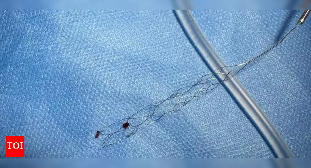 Stent to remove brain clots gets nod in India | Kolkata News - The ...