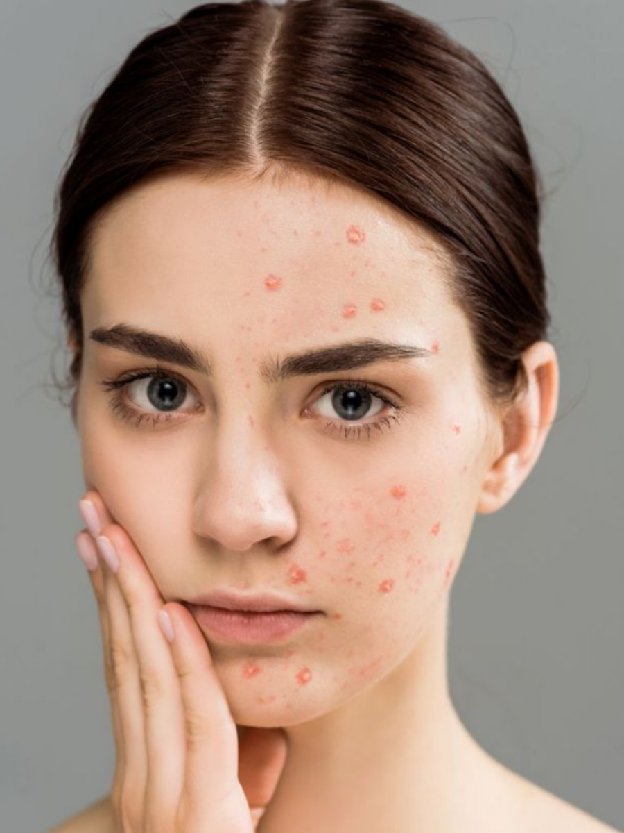 Acne map: 8 face areas most prone to acne | Times of India