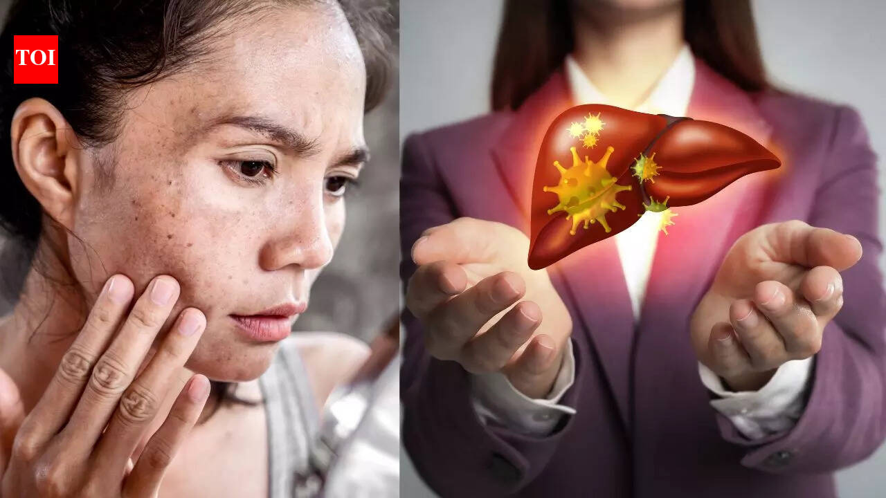 Dark spots on skin and its link with liver: 5 things to know