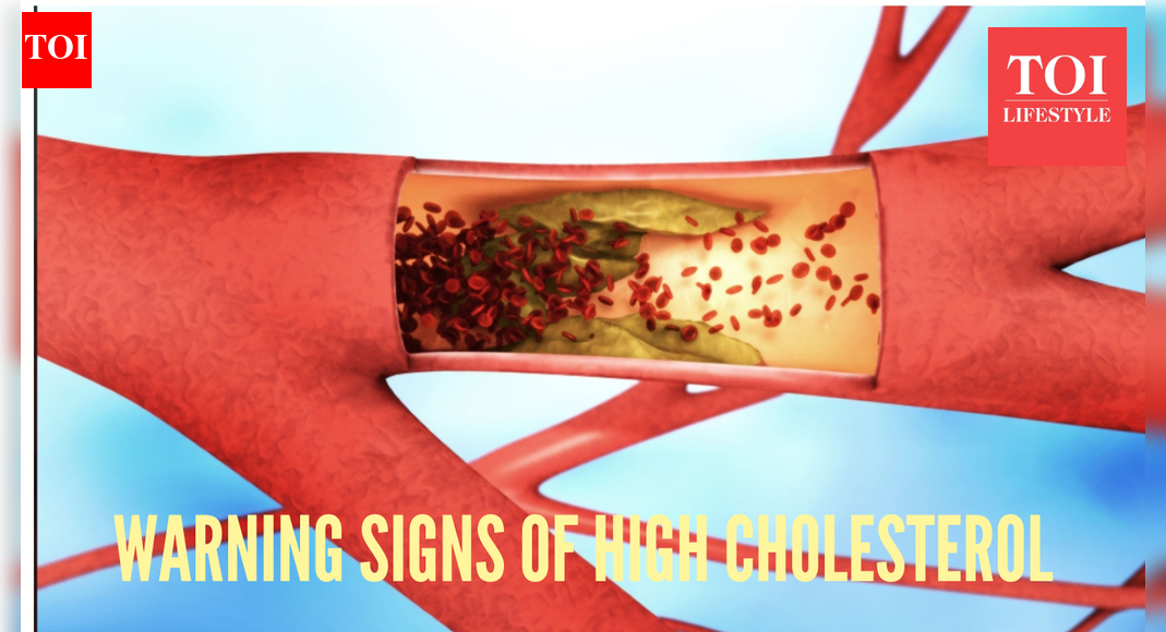 High Cholesterol Symptoms: 5 warning signs of high cholesterol in the ...