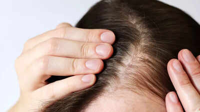 9 Signs of hormone imbalance on your face: Visible facial signs of ...