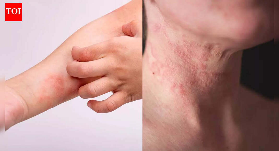 contact dermatitis: understanding the common skin reaction; causes ...
