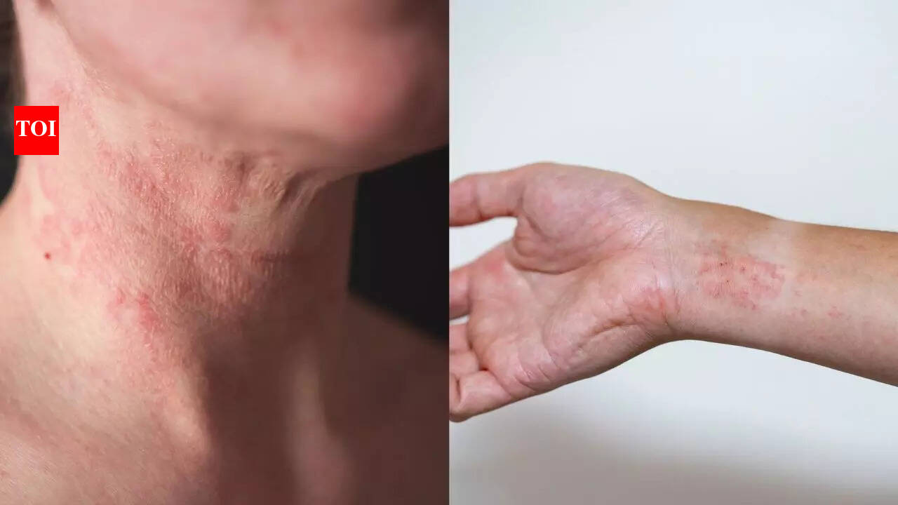 Dermatitis Neck