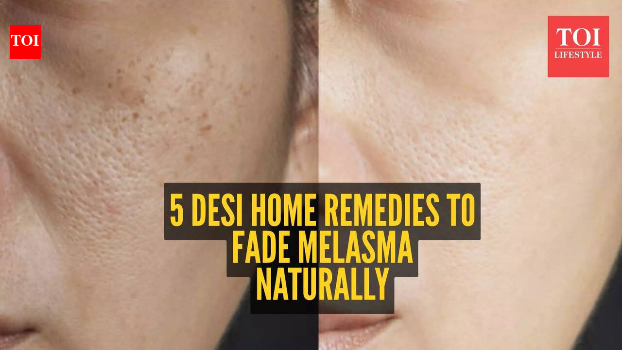 5 home remedies to get rid of Melasma (Jhai)