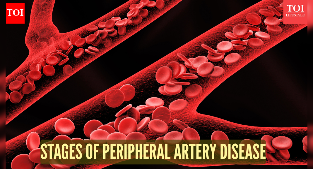 4 stages of peripheral artery disease: From mild circulation issues to ...