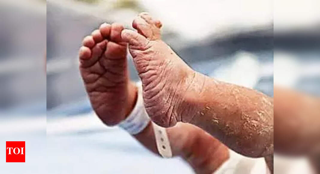 Neonatal experts boost hope for preterm infants | Hyderabad News - The ...